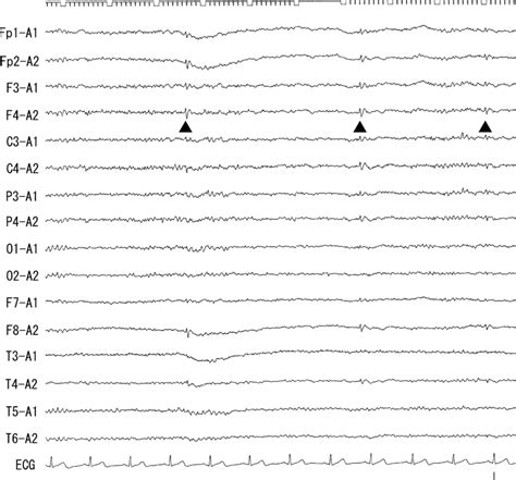 Electroencephalogram Of An Applicant Download Scientific Diagram