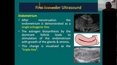 Ultrasound Of Normal First Trimester Youtube