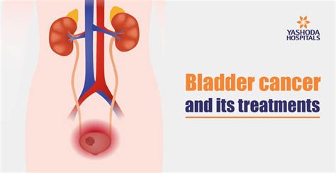 Bladder Cancer Causes Symptoms Diagnosis And Treatment