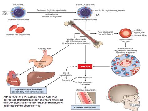 Mbbs Medicine Humanity First Thalassemia