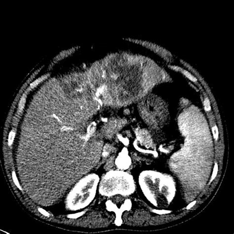 Intrahepatic Cholangiocarcinoma Image