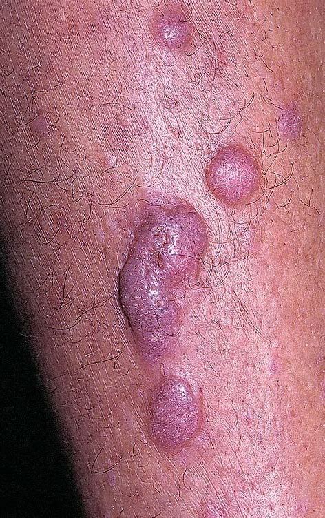 Prurigo Nodularis الاكال العقيدي