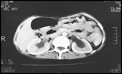 Abdominal Computerized Tomography Scan For The Same Patient As Figure 1