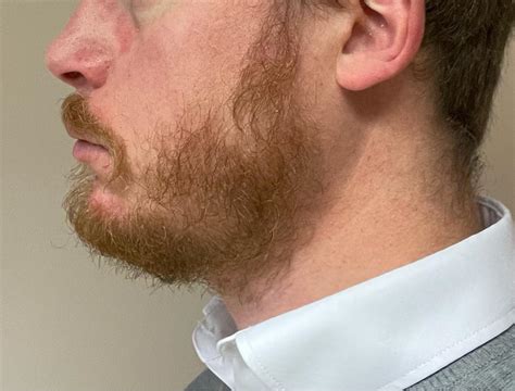 Patchy Beard Success Stories Before And After Photos Page 47 Beard