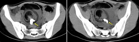 Mature Ovarian Teratoma Radiology Cases