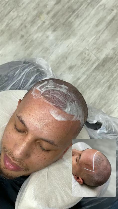 Afro Hair Transplant In Turkey Artofit