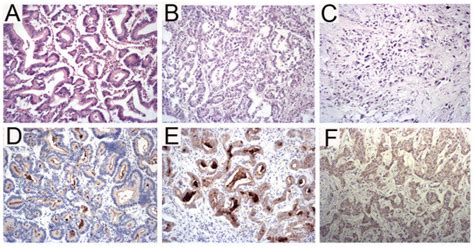The Expression And Different Subcellular Localization Of Cd133 In Cc