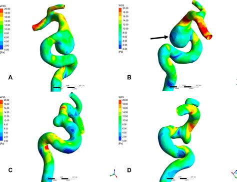 Figure 2 From Hemodynamic And Morphological Analysis Of Mirror