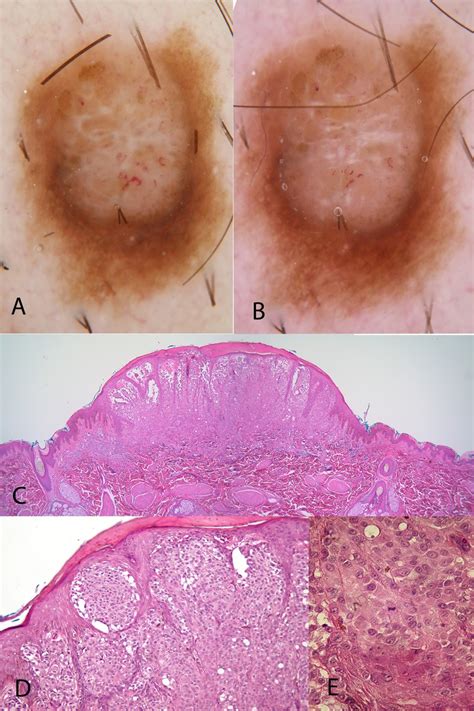 Case 1 A Non Polarized Dermatoscopic Image B Polarized