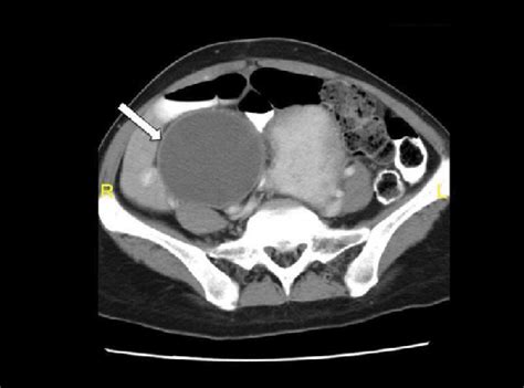 Ovarian Cyst Ct Scan
