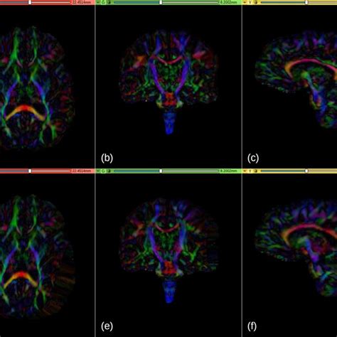 Diffusion Tensor Images Dtis Of The Brain A B C Acquired
