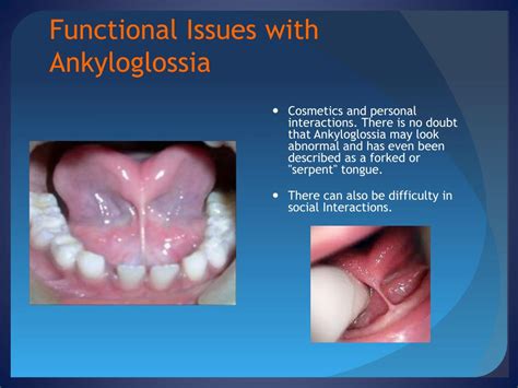 Ppt Ankyloglossia Powerpoint Presentation Free Download Id 2078965