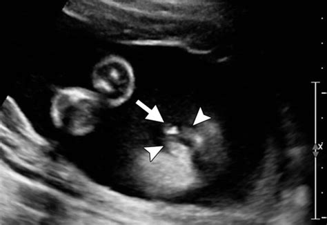 Evaluation And Management Of Disorders Of Sex Development