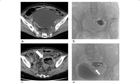 A Contrast Enhanced Computed Tomography Ct After Gynecological Cancer