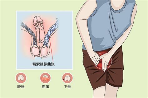 What Is The Varicocele How To Treat It Imedia