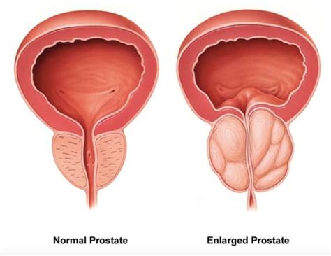 Benign Prostatic Hypertrophy Bph Prostate Enlargement South West