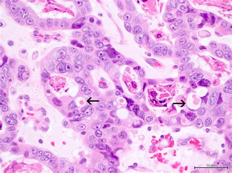 Pathology Outlines Clear Cell Carcinoma