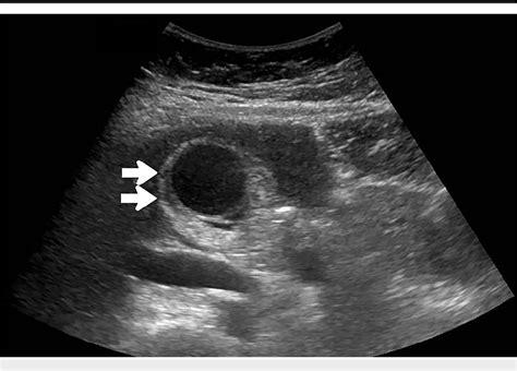 Figure 1 From Incidental Finding Of Acute Appendicitis During