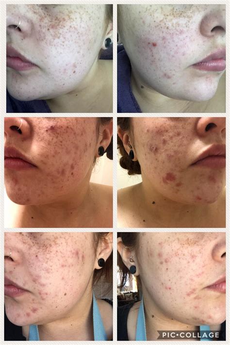 [banda] 1 Year Progress With Cystic Acne R Skincareaddiction