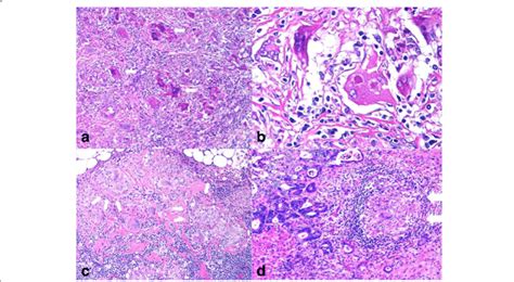 Histopathological Findings A Histopathological Findings In The