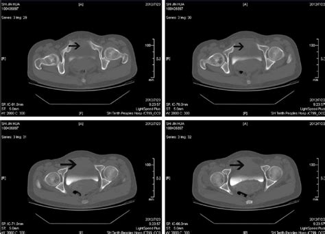 Computerized Tomography Scan Of The Pelvis Showing Tumor Located In The