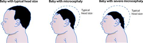 Fetal Microcephaly The Bmj