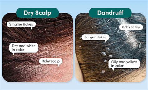 A Complete Guide Of Using Virgin Coconut Oil For Dry Scalp