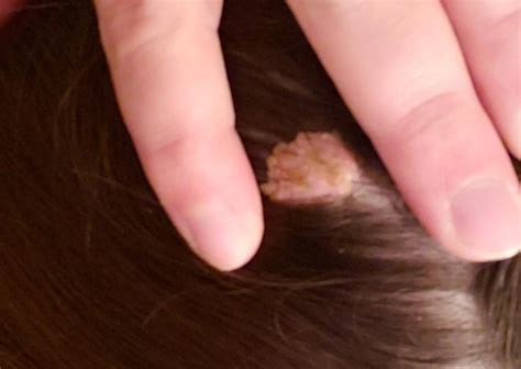 Raised Bump On Scalp With Dry Skin Coming Out Of It Been There For