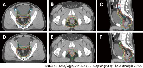 Improving The Accuracy And Consistency Of Clinical Target Volume