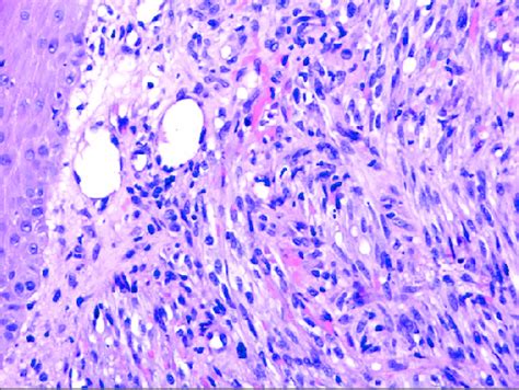 The Biopsy Specimen Showed Tumoral Cell Proliferation Consisting Of