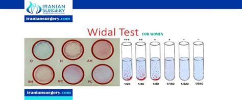 widal test iranian surgery