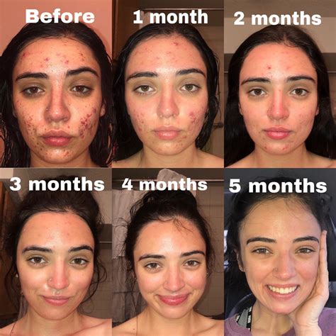 My Accutane Journey I Feel Like A New Person R Accutane