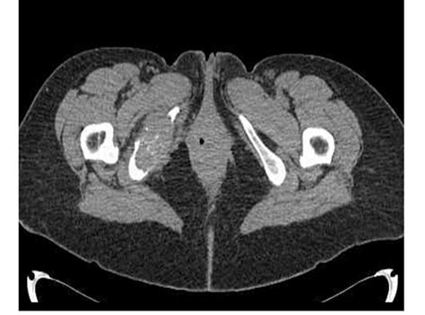 The Computed Tomography Scan Of The Pelvis Confirms The Presence Of An