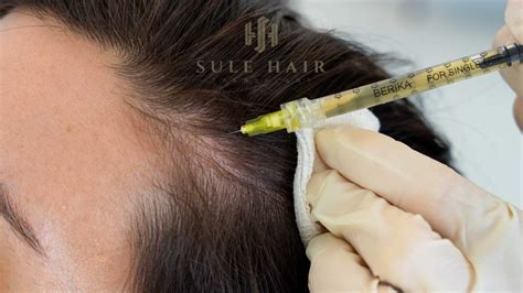 Stem Cell Hair Transplant Sule Hair Transplant