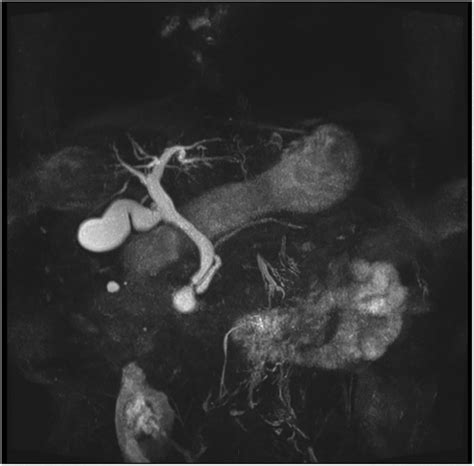 incidental choledochocoele imaging and endoscopic findings bmj case