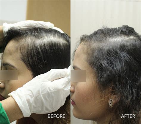 Best Hair Clinic In Delhi Dadu Medical Centre