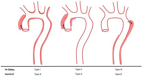 Management Of Acute Aortic Dissection In Critical Care Luke Flower