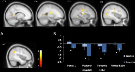 The Brain Activation During The N Back Task Between Two Times In The
