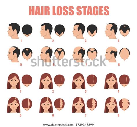 Hair Loss Stages Vector Isolated Female Stock Vector Royalty Free