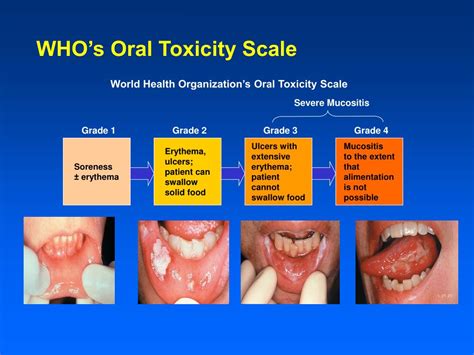 Ppt Coding For Mucositis Powerpoint Presentation Free Download Id