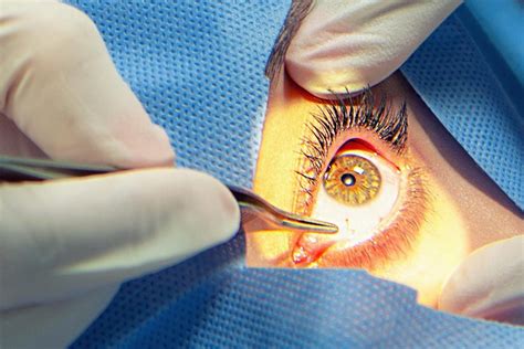 ¿qué Son Los Lentes Intraoculares Como Cuidar Los Ojos