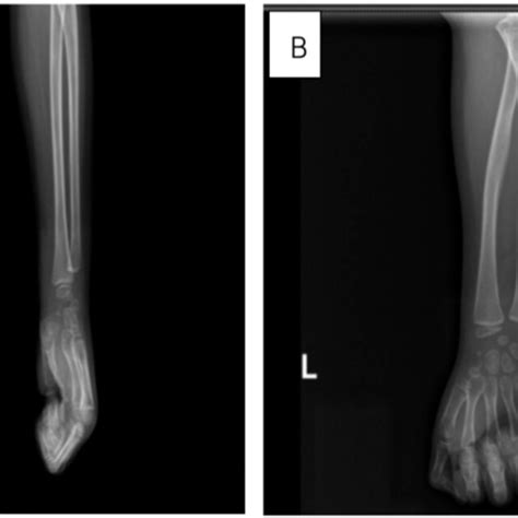 Anteroposterior And Lateral Radiographs Of The Left Forearm Showed No