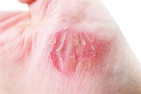 Atopic Dermatitis Ad Also Known As Atopic Eczema Is A Type Of Skin