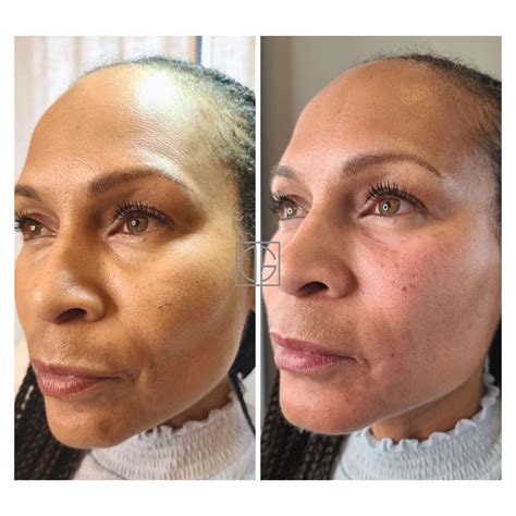 Sculptra Injection Derma Secret