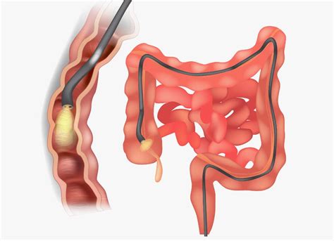 Colonoscopy Oxford Gut And Liver