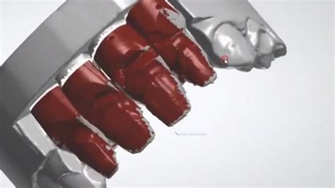 How Dental Veneers Are Installed On Teeth In Four Stages Veneers Dubai