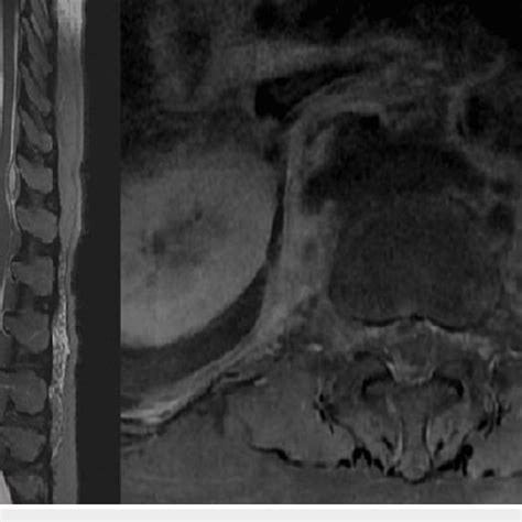 T2 Weighted Fat Suppressed Magnetic Resonance Images Prevertebral And