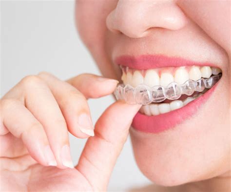 What Is Invisalign® Treatment How Does Invisalign Treatment Work