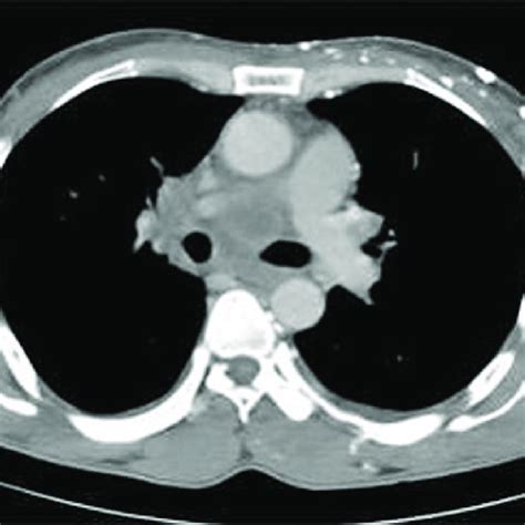 Axial Contrast Enhanced Computed Tomography Image Demonstrating