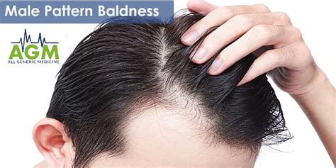About Male Pattern Baldness Causes Symptoms And Treatment Options